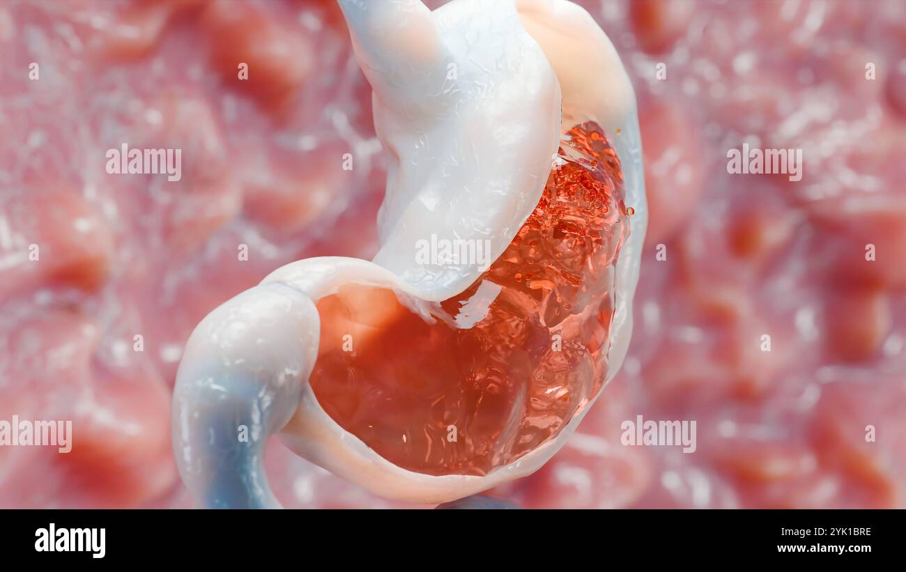 Stomach Acid Relux. Esophagus, gerd. Pain In The Digestive System ...
