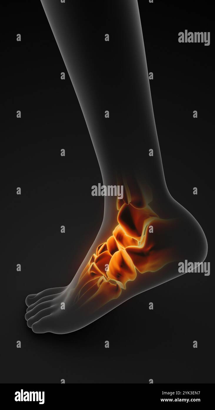 Chronic Ankle Joint Pain and Inflammation Syndrome Stock Photo - Alamy