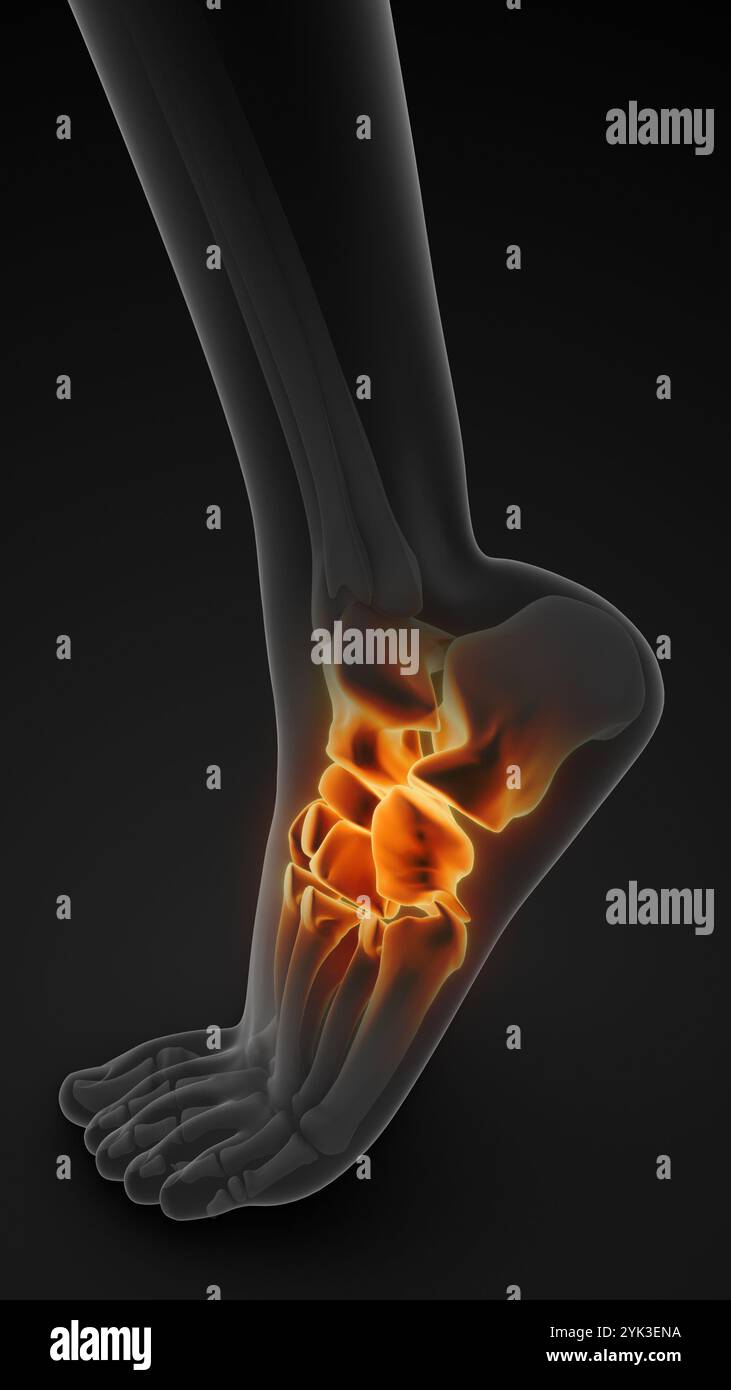 Chronic Ankle Joint Pain and Inflammation Syndrome Stock Photo - Alamy