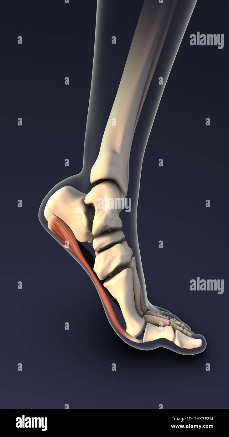 Plantar Fascia Ligament Overstrain and Dysfunction Stock Photo - Alamy