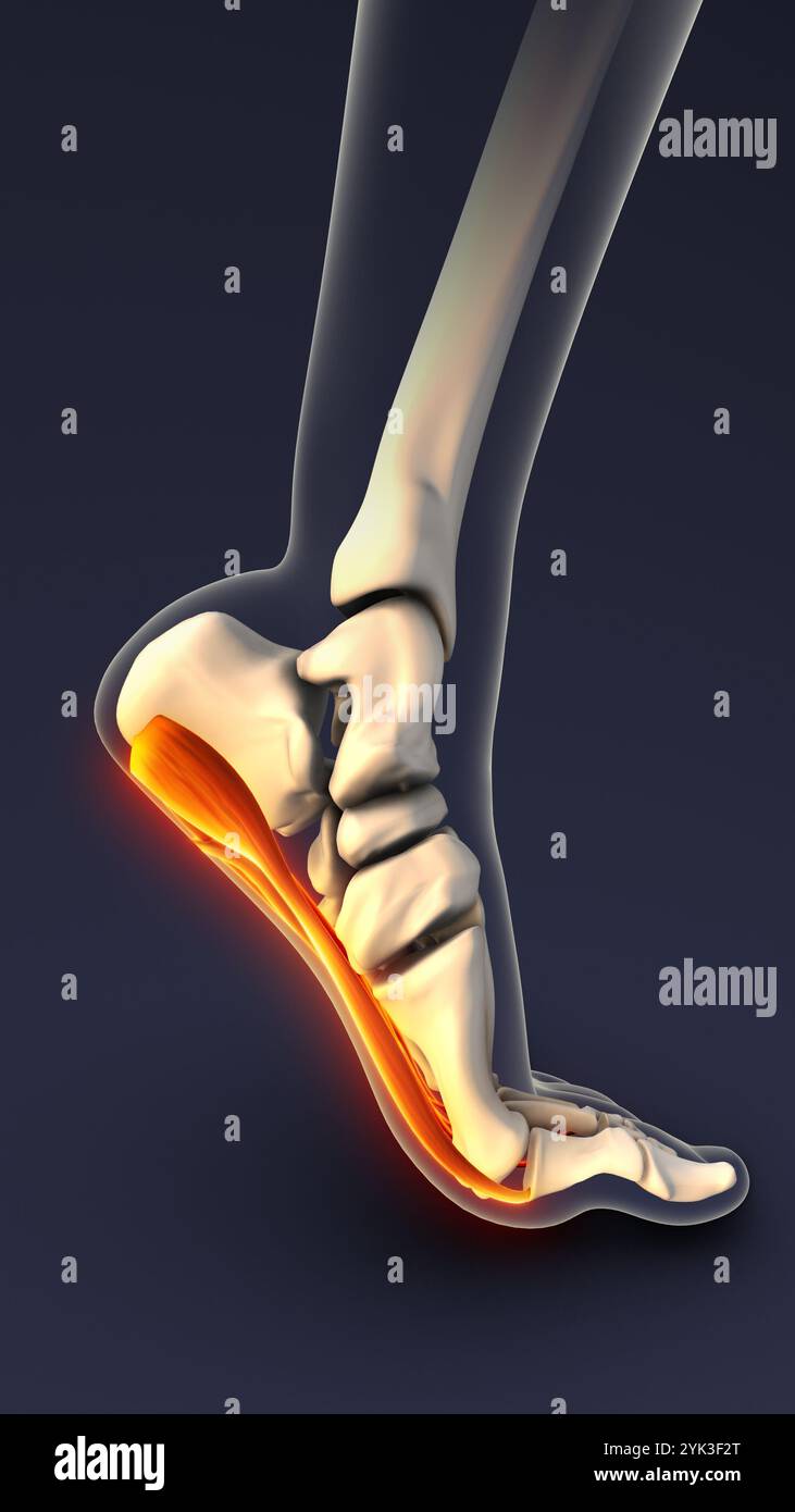 Plantar Fascia Ligament Overstrain and Dysfunction Stock Photo - Alamy