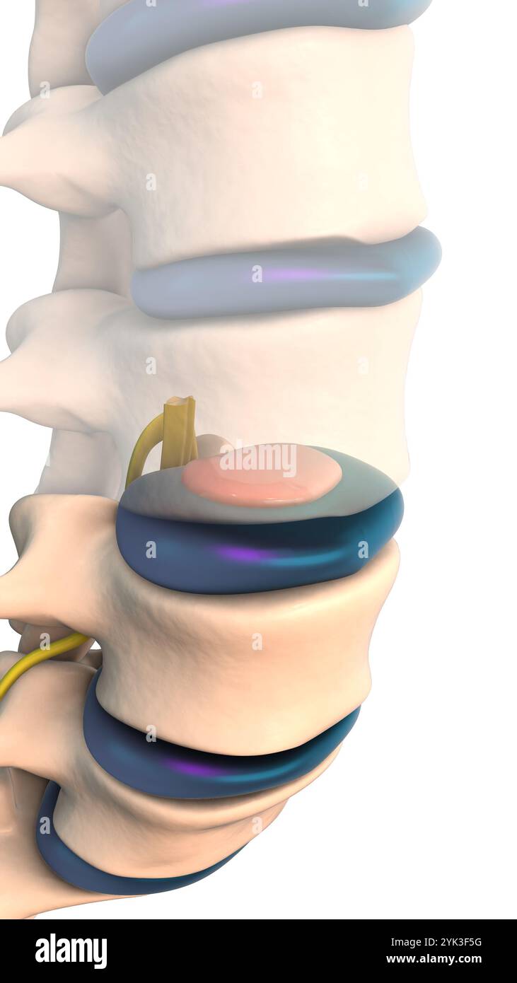 Ruptured disk hi-res stock photography and images - Alamy