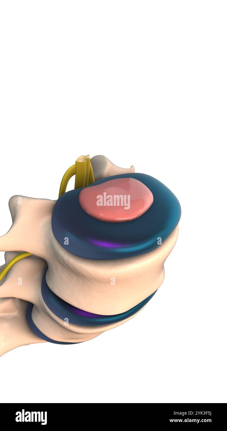 Ruptured disk hi-res stock photography and images - Alamy