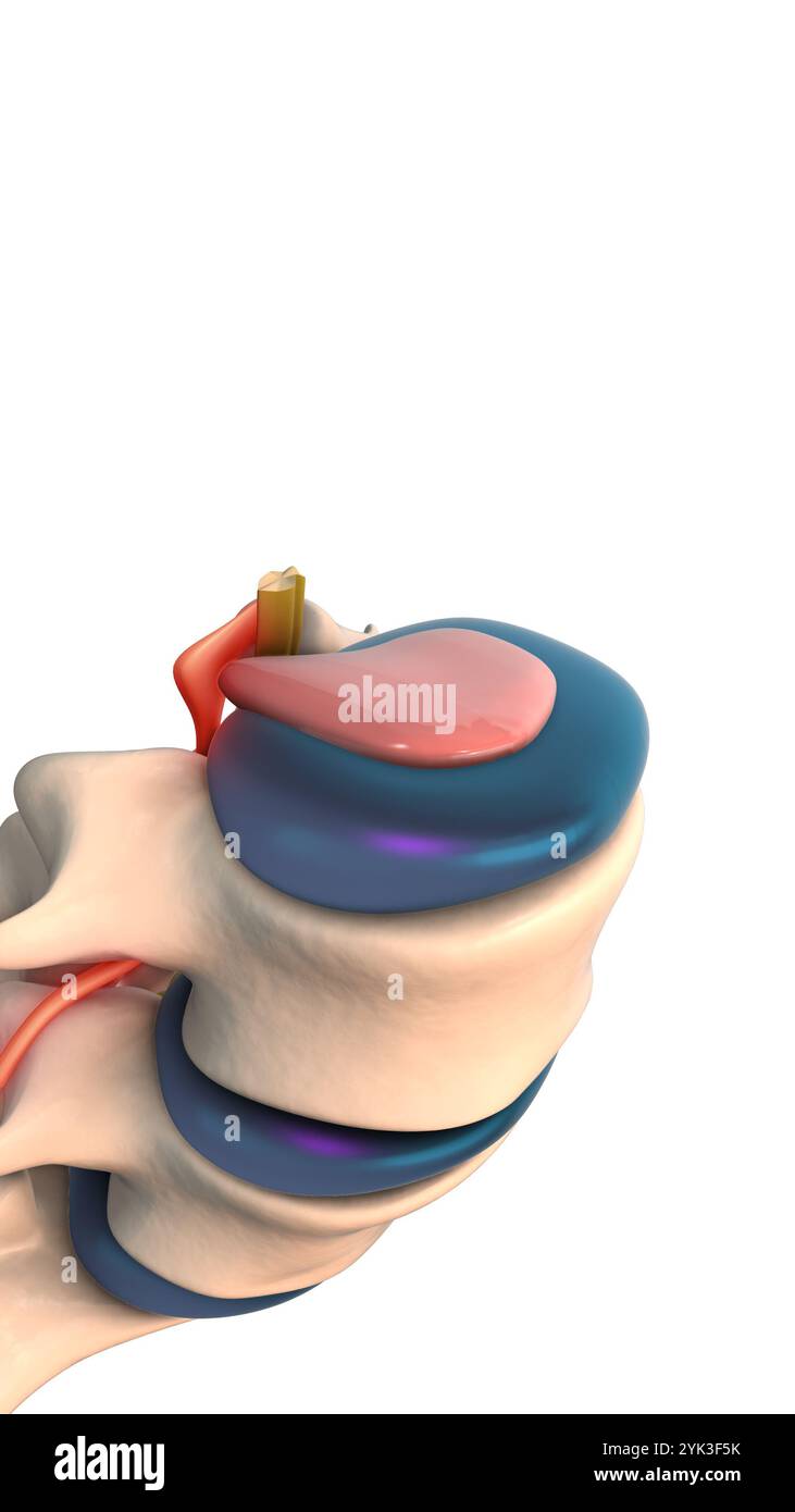Slipped disk or a ruptured disk Stock Photo - Alamy