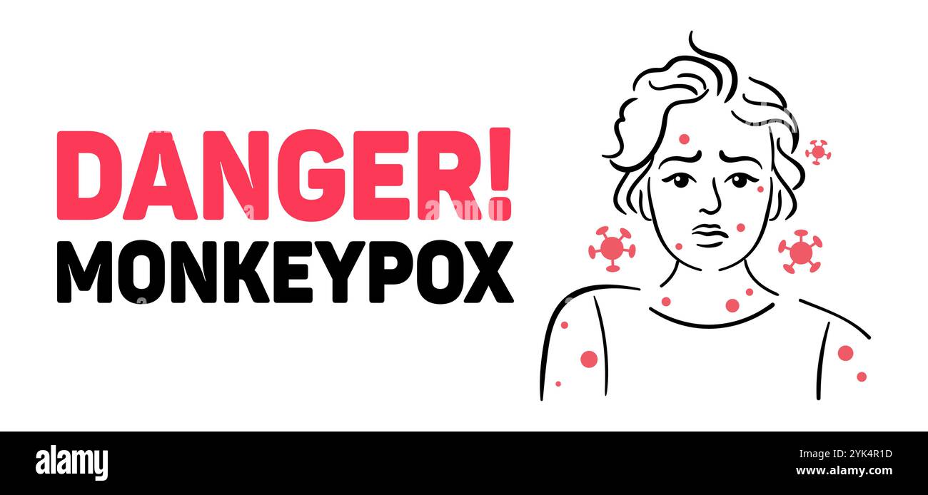 Increasing Awareness of Monkeypox Essential Health Precautions and ...