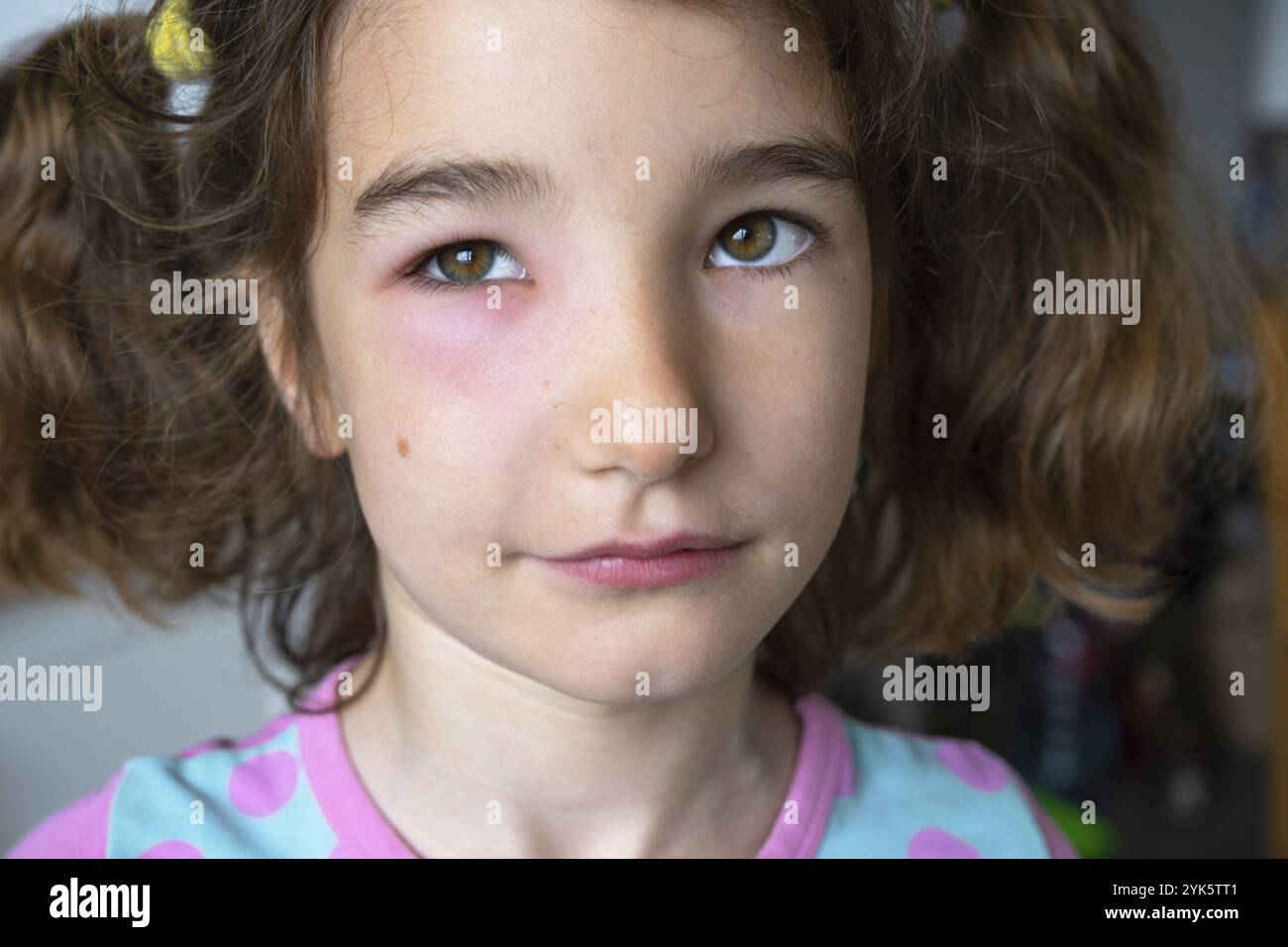 A red swollen eyelid on a child face in close-up is an allergy to an ...