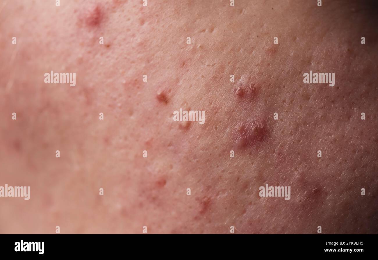 Dermatological acne. Skin texture background. Closeup acne pimple ...