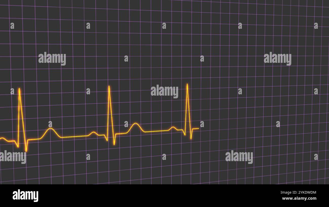 Normal heart rhythm ECG electrocardiogram of a healthy person, heart ...
