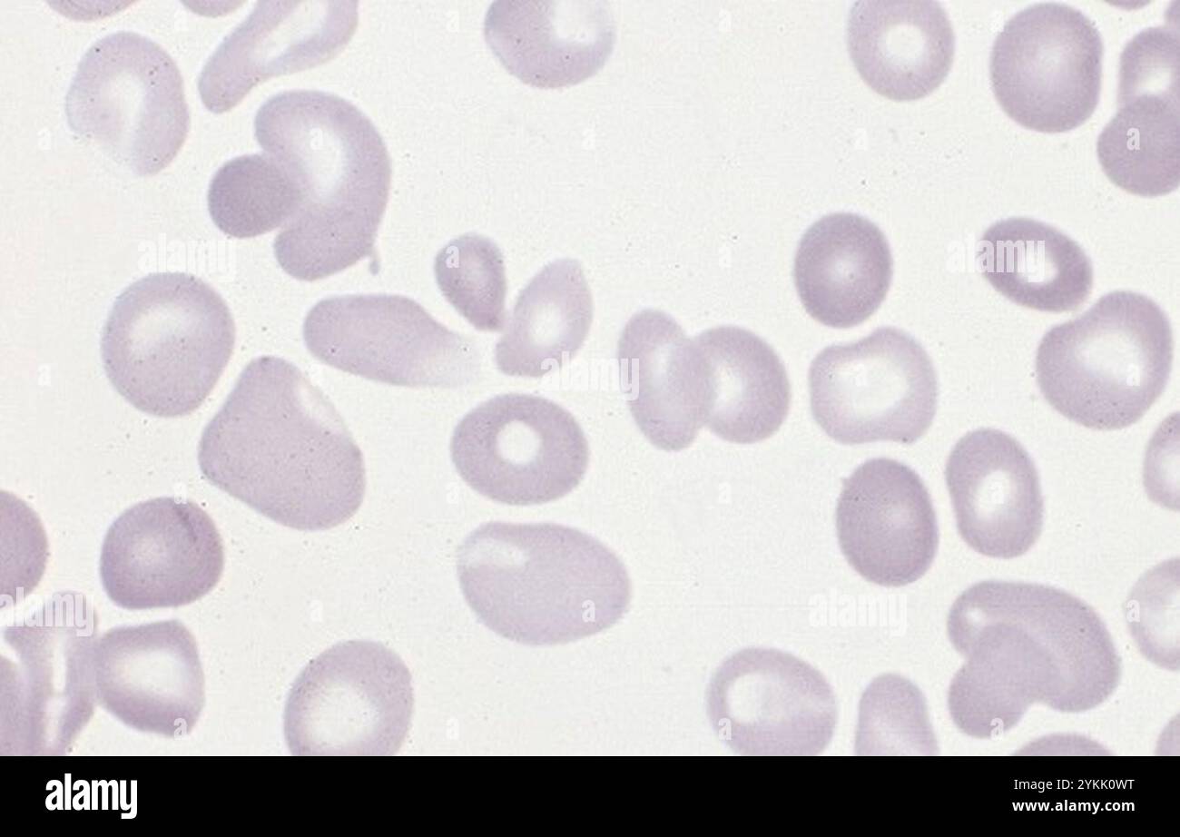 Blood smear of anisopoikilocytosis in polycythemia vera Stock Photo - Alamy