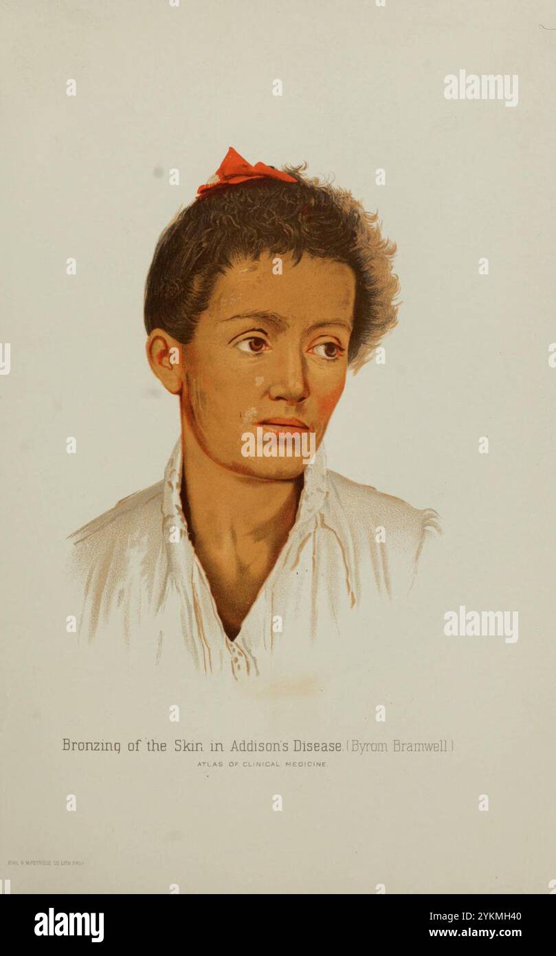 Bronzing of the skin in Addison's disease Bramwell Stock Photo - Alamy