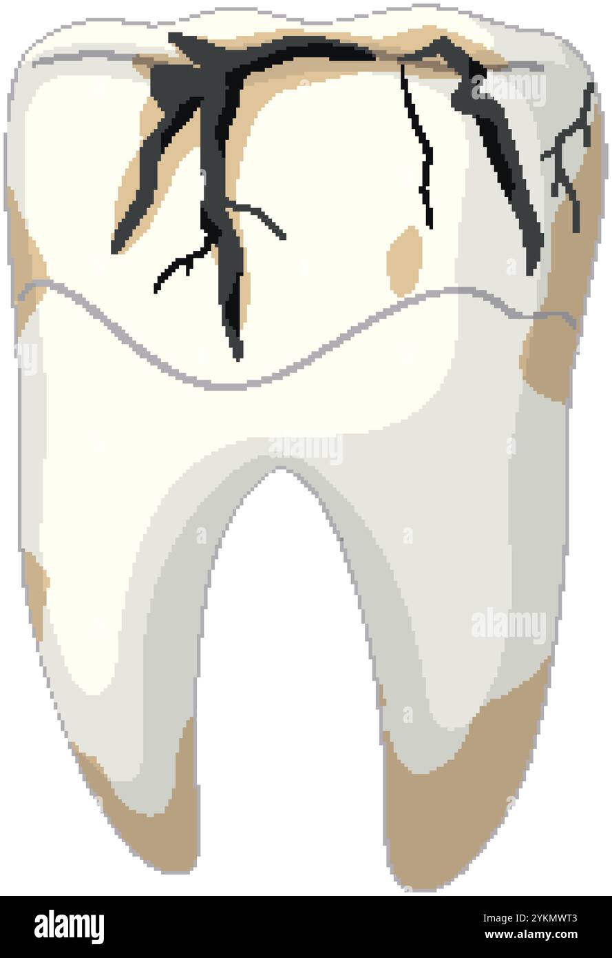 Illustration of a cracked, decayed tooth Stock Vector Image & Art - Alamy