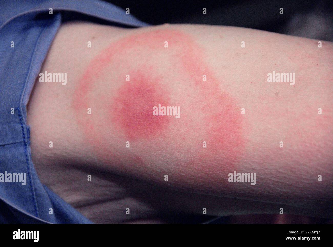 Bullseye rash linked to Lyme disease rotated Stock Photo - Alamy
