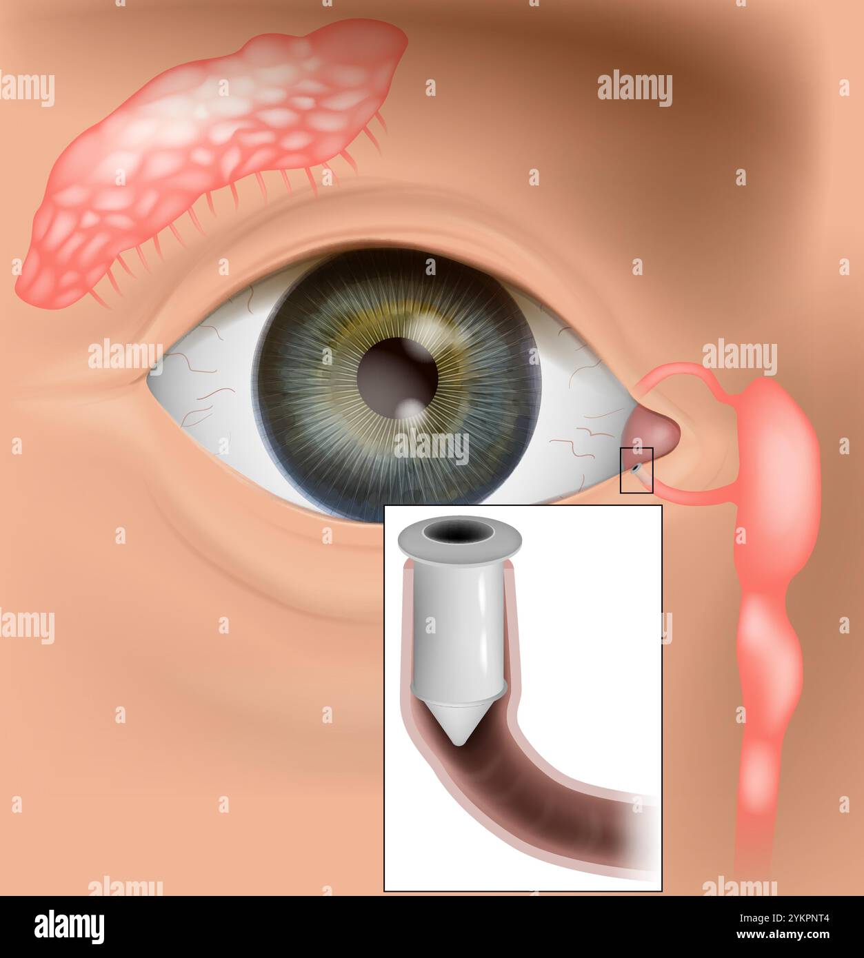 Punctal Occlusion Therapy. Punctal Plugs for Treatment of dry eye ...