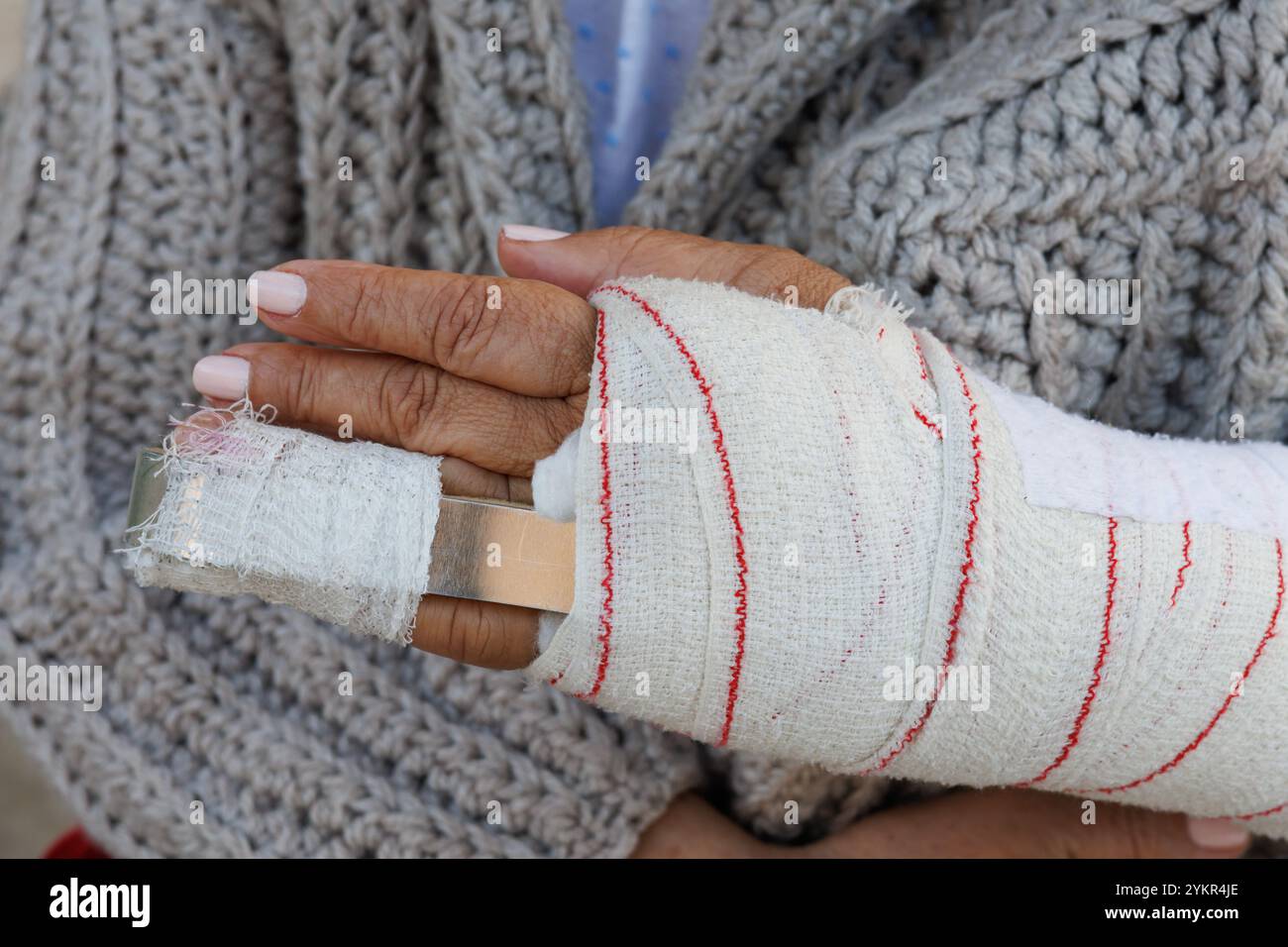 Bandage with splint to immobilize a fracture or injury to the ring ...