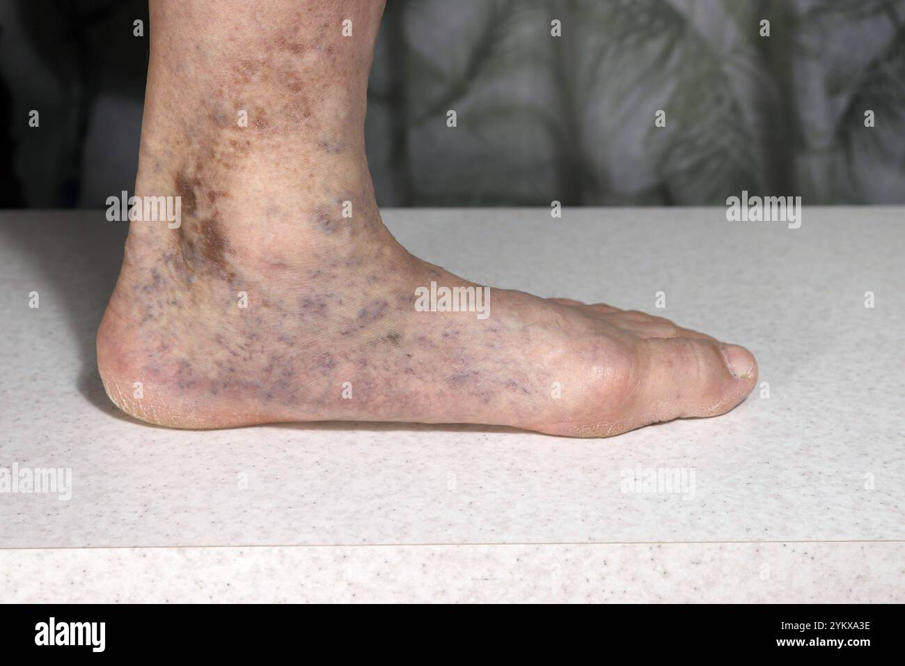 The lower part of a human leg with clearly visible blood vessels and ...