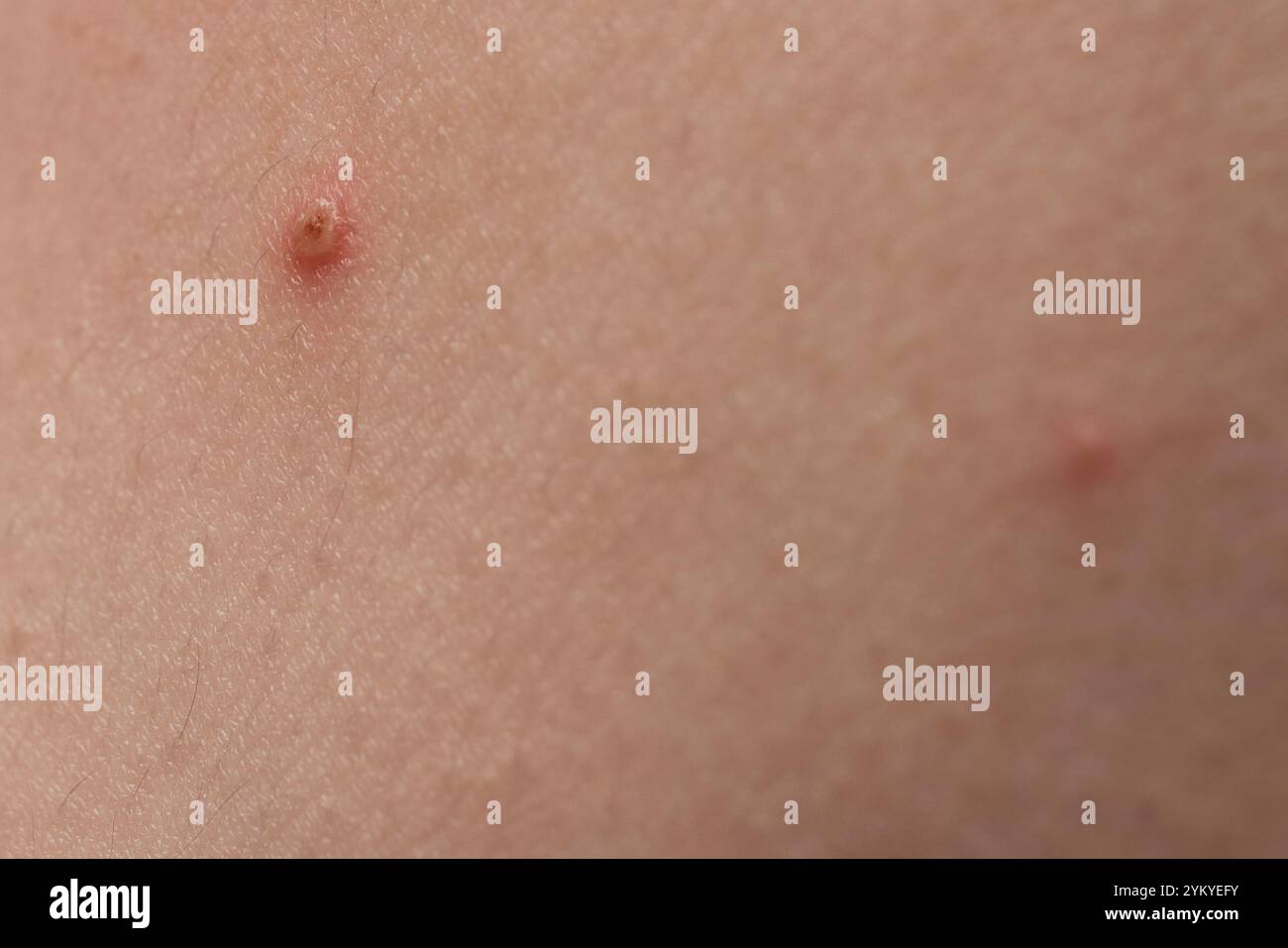 Pimple closeup. Acne and pimple. Skin care. Dermatology skincare ...