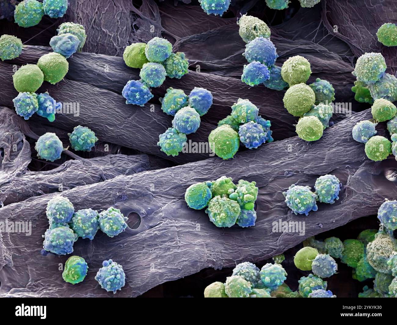 Leukaemia blood cells. Coloured scanning electron micrograph (SEM) of ...