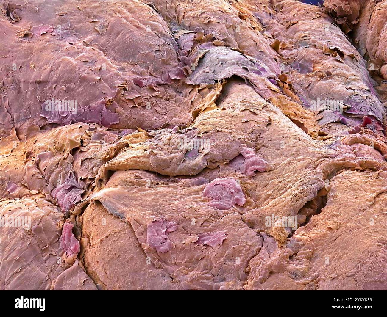Wound scab. Coloured scanning electron micrograph (SEM) of ...