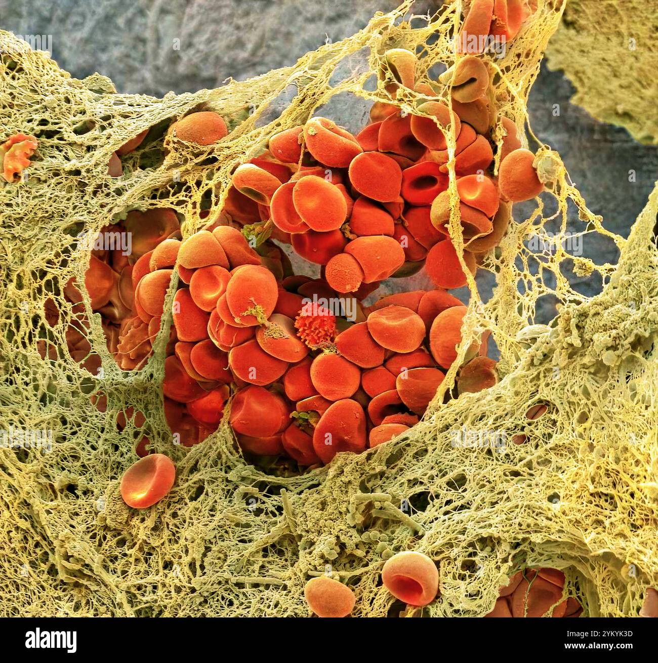 Blood clot. Coloured scanning electron micrograph (SEM) of red blood ...