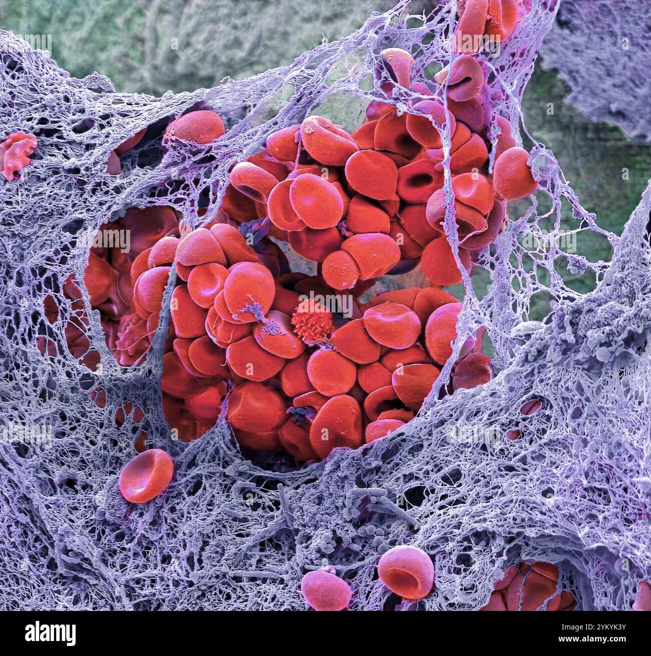 Blood clot. Coloured scanning electron micrograph (SEM) of red blood ...