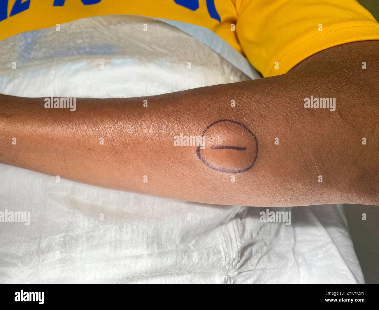 Lipoma marked for excision on the arm of a 68 year old Hispanic male ...