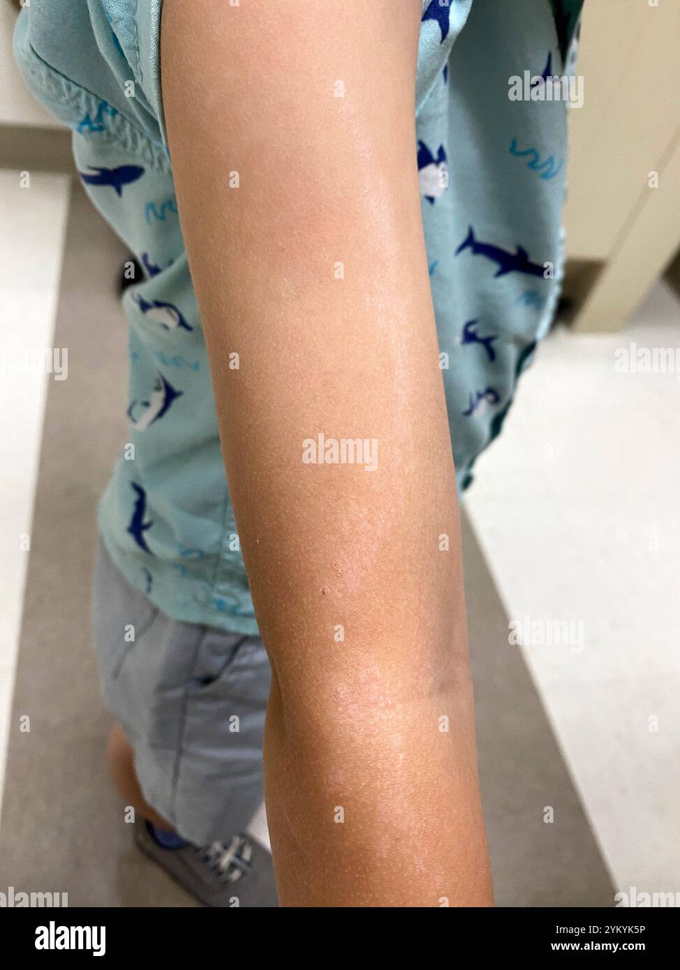 Lichen striatus on a patient's arm. Lichen striatus is a rare, benign ...