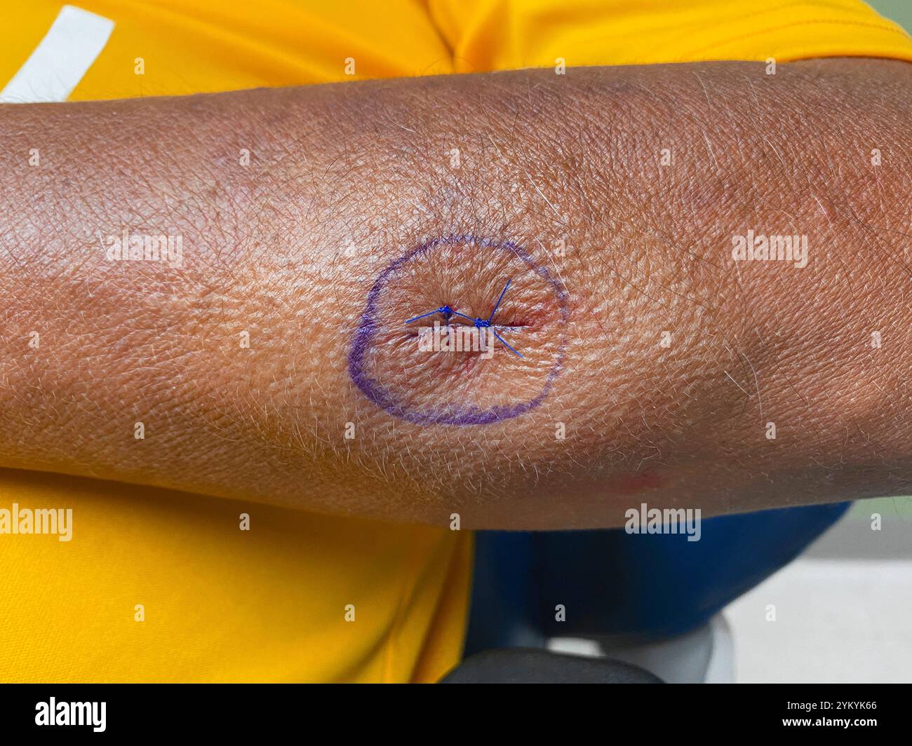 Marks and stitches on the arm of a 68 year old Hispanic male patient ...