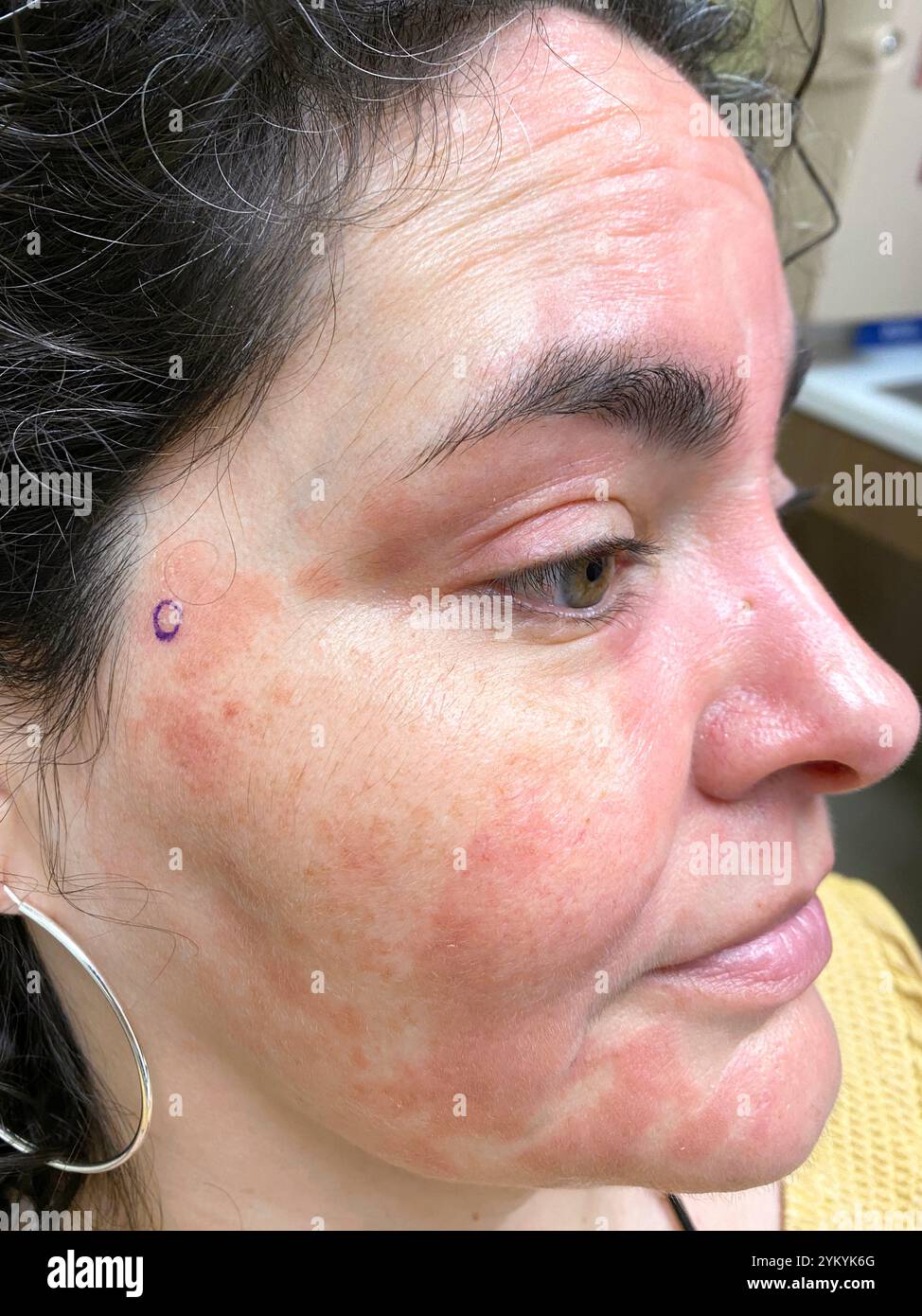 Redness on the face of a patient with cutaneous lupus erythematosus (LE ...