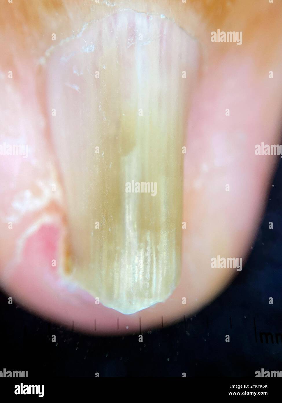Dermatoscope image of the nail of a patient with onychomatricoma. This ...
