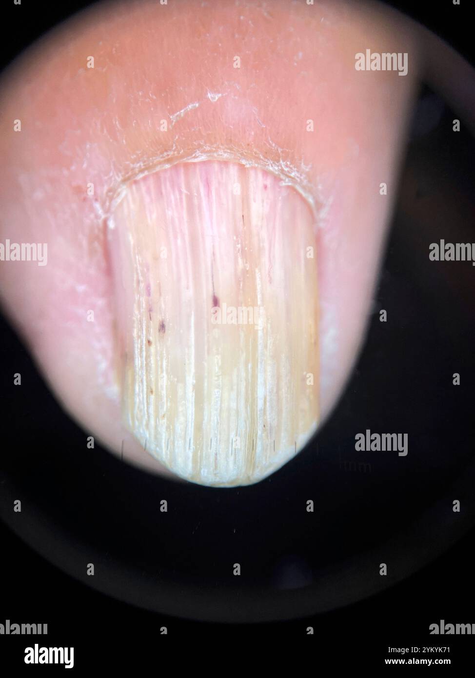 Dermatoscope image of the nail of a patient with onychomatricoma. This ...