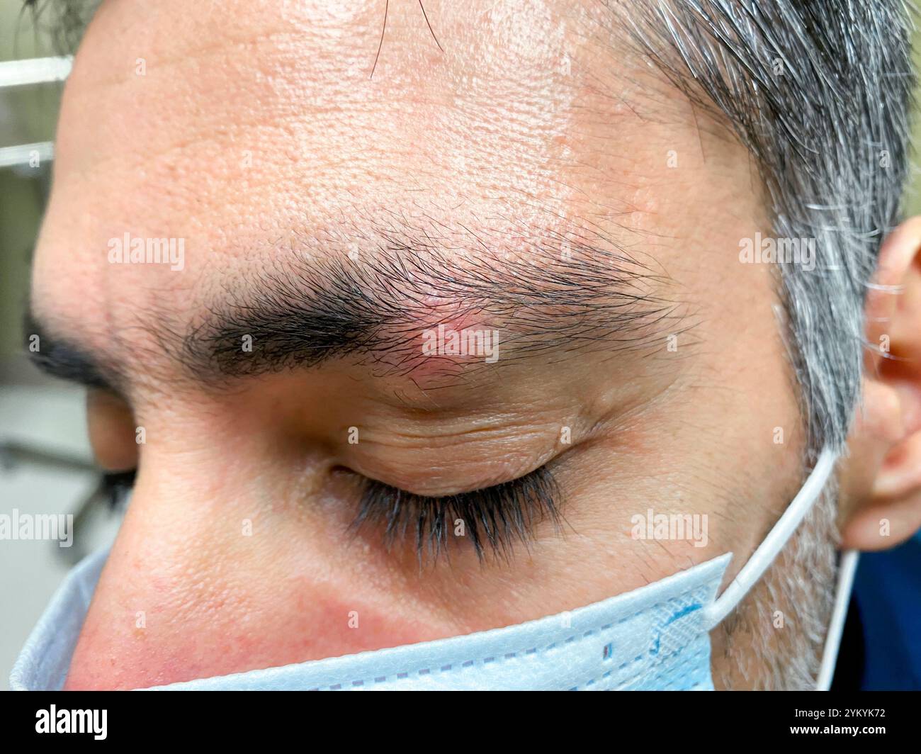 Pilomatricoma lesion above a patient's eye. This benign (non-cancerous ...