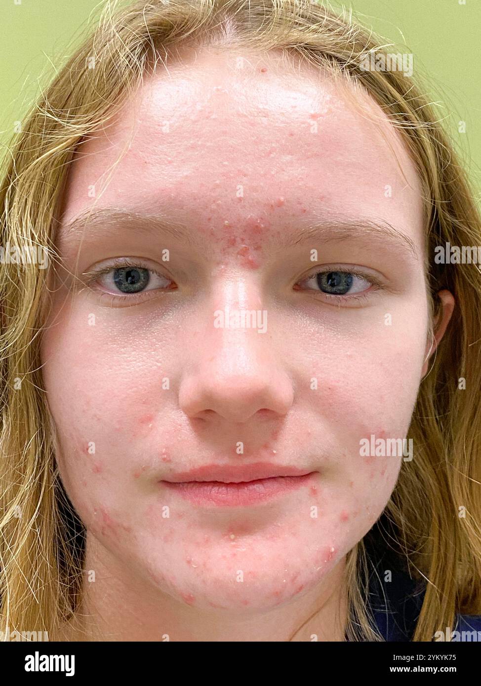 Acne on the face of a 15 year old white female patient. Acne is a ...
