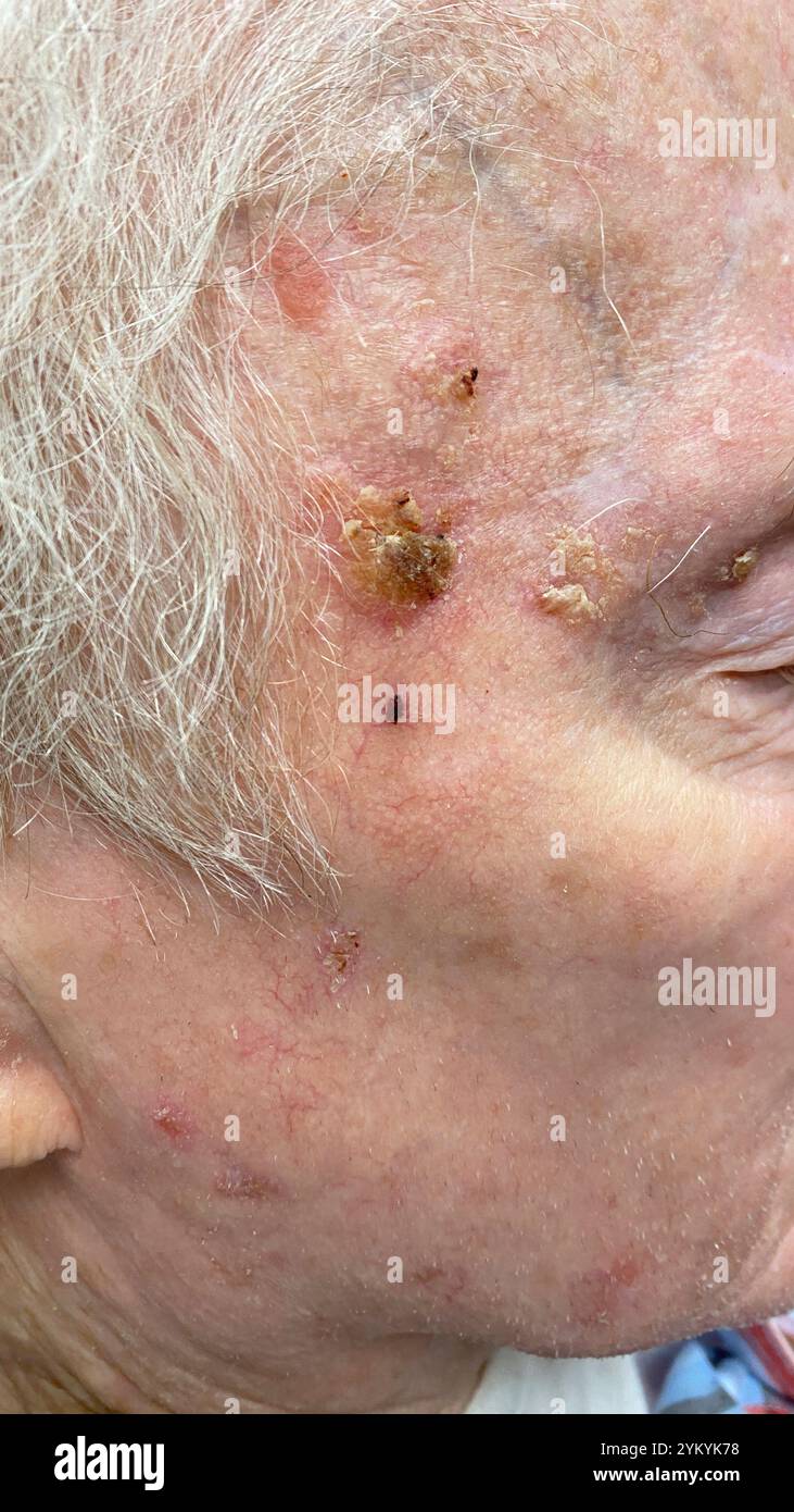 Squamous cell carcinomas on the temple of a 75 year old white male ...
