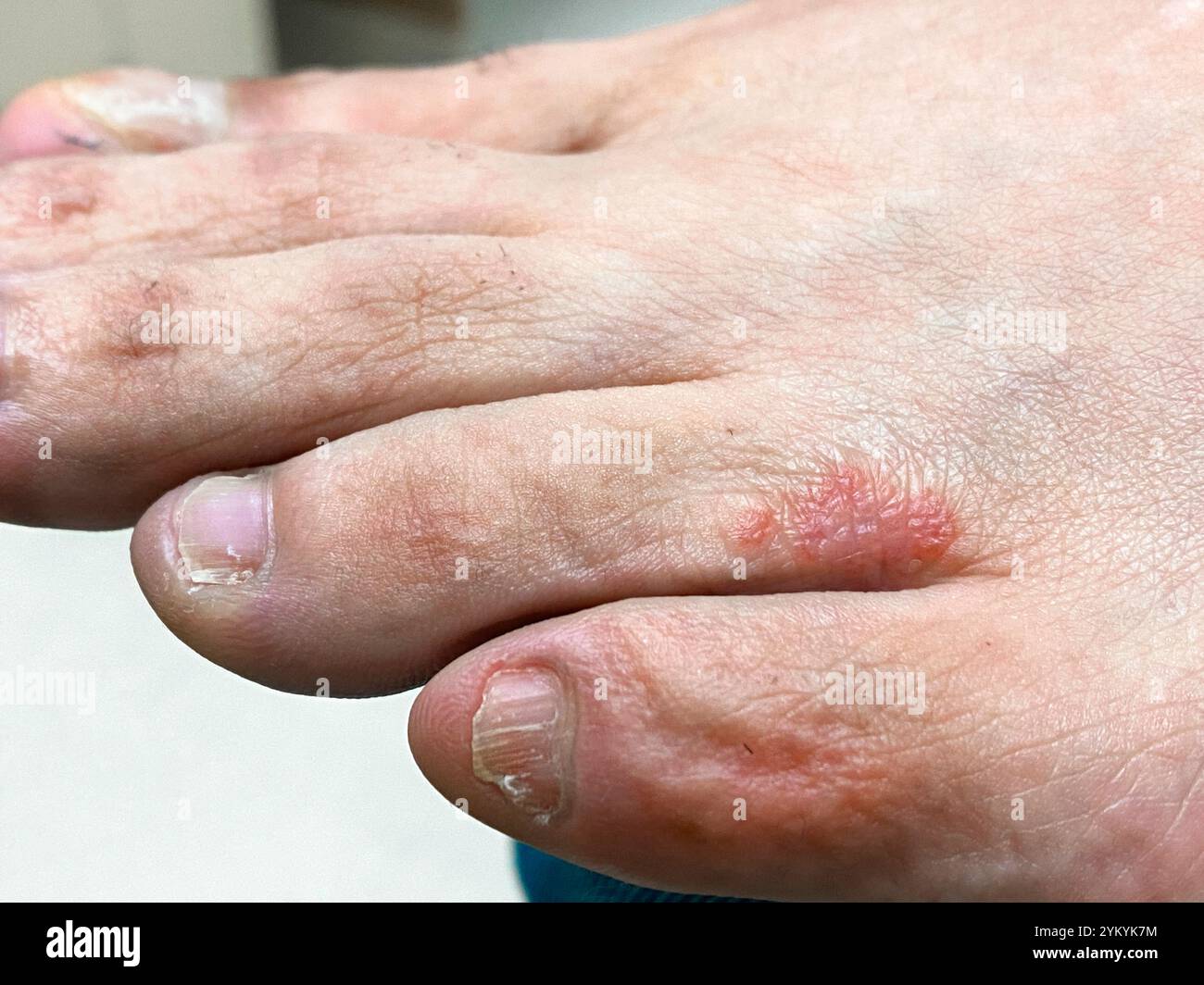 Psoriasis on a patient's foot. Psoriasis is a skin condition where ...
