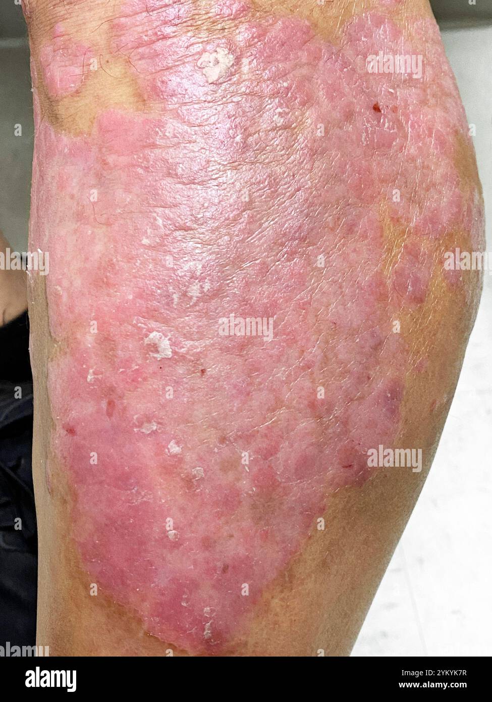 Psoriasis on a male patient's leg. Psoriasis is a skin condition where ...