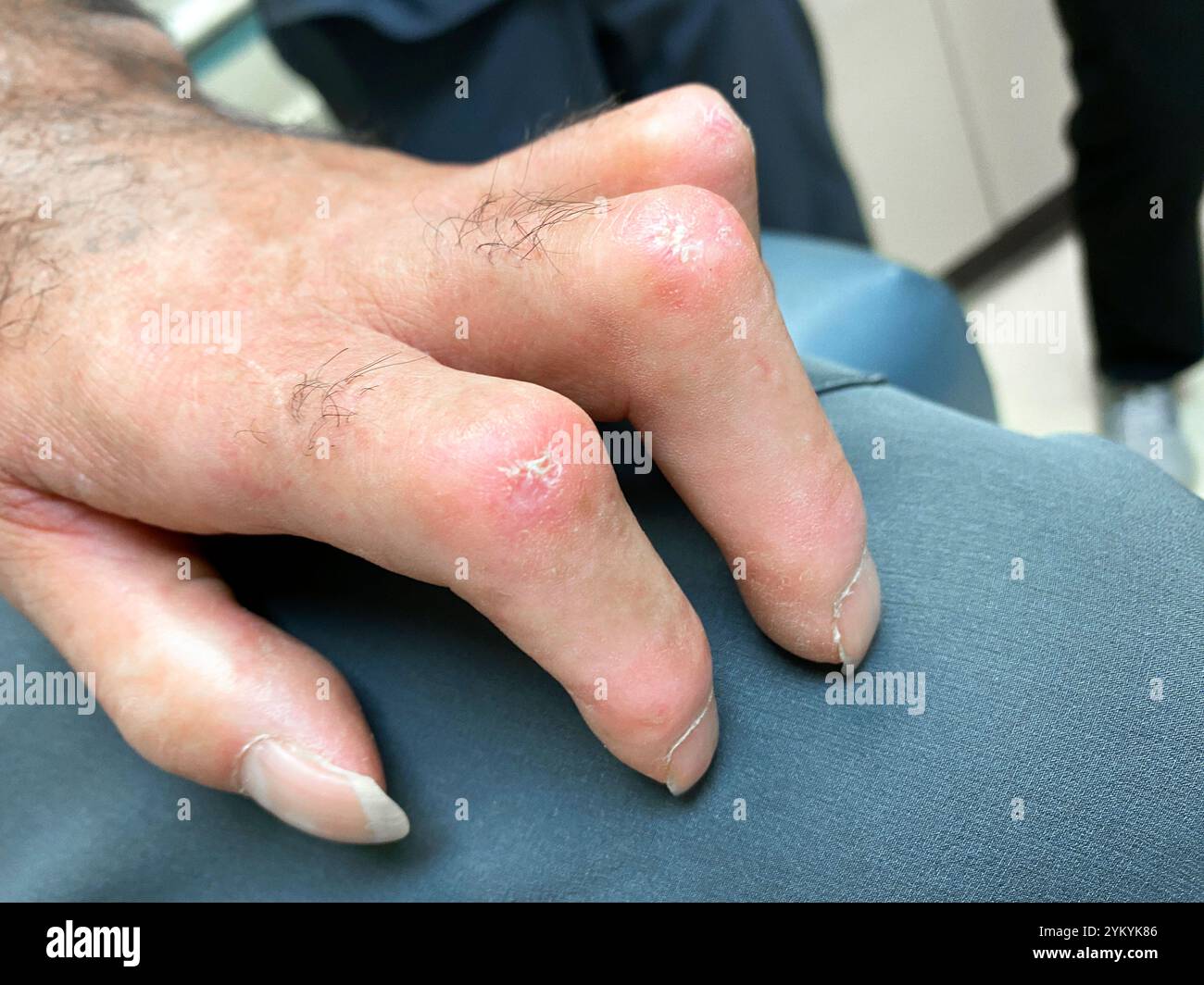 Scleroderma affecting a Hispanic male patient's fingers. Scleroderma ...