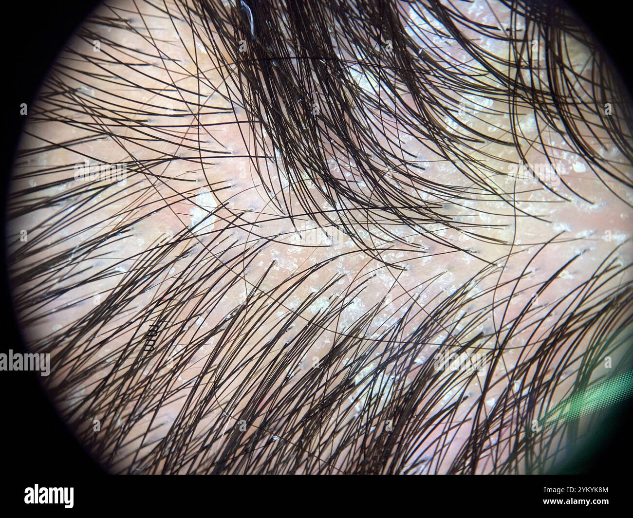 Dermatoscope image of seborrheic dermatitis on a patient's scalp. This ...