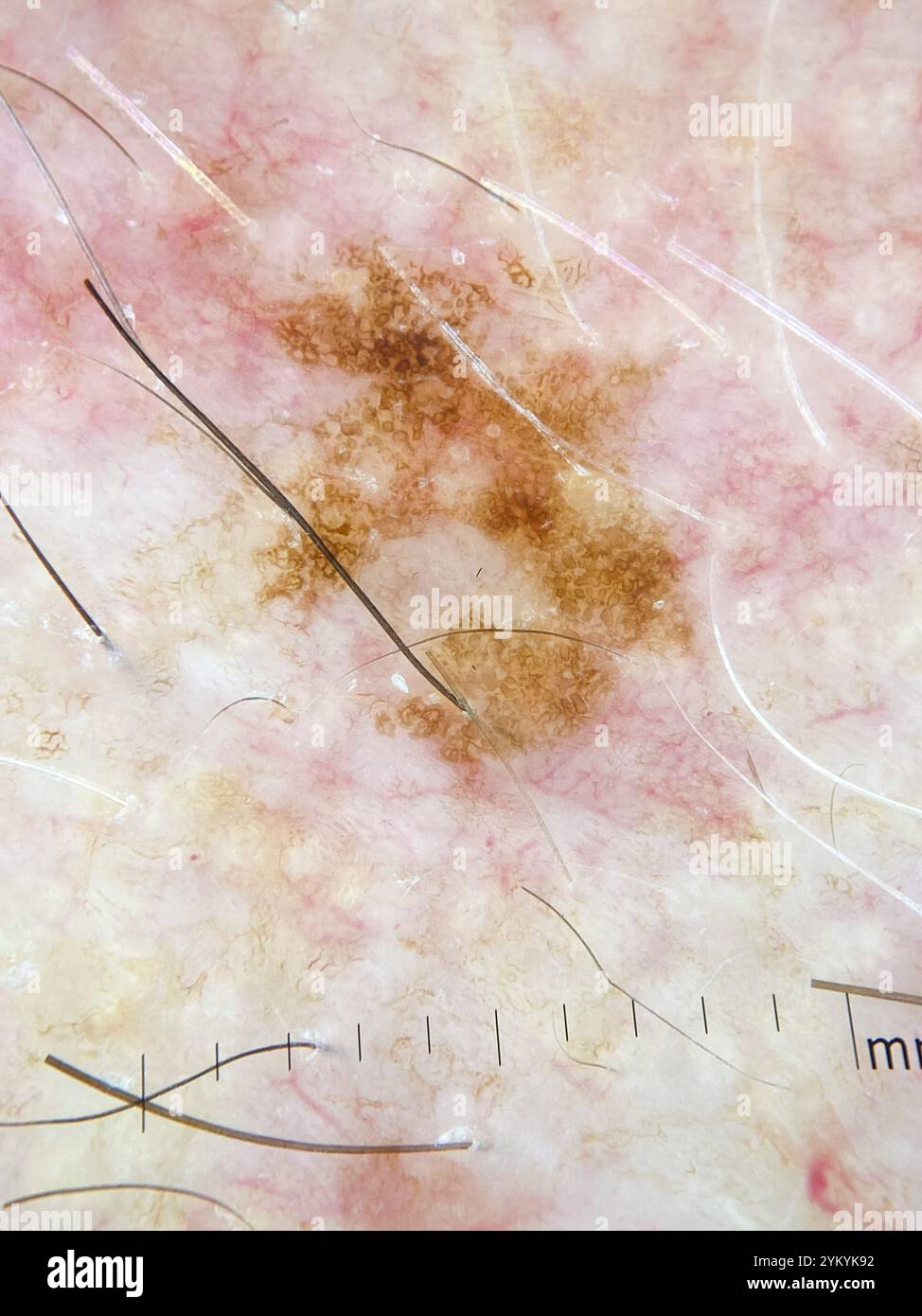 Dermatoscope image of a seborrheic keratosis on the chest of a 62 year ...