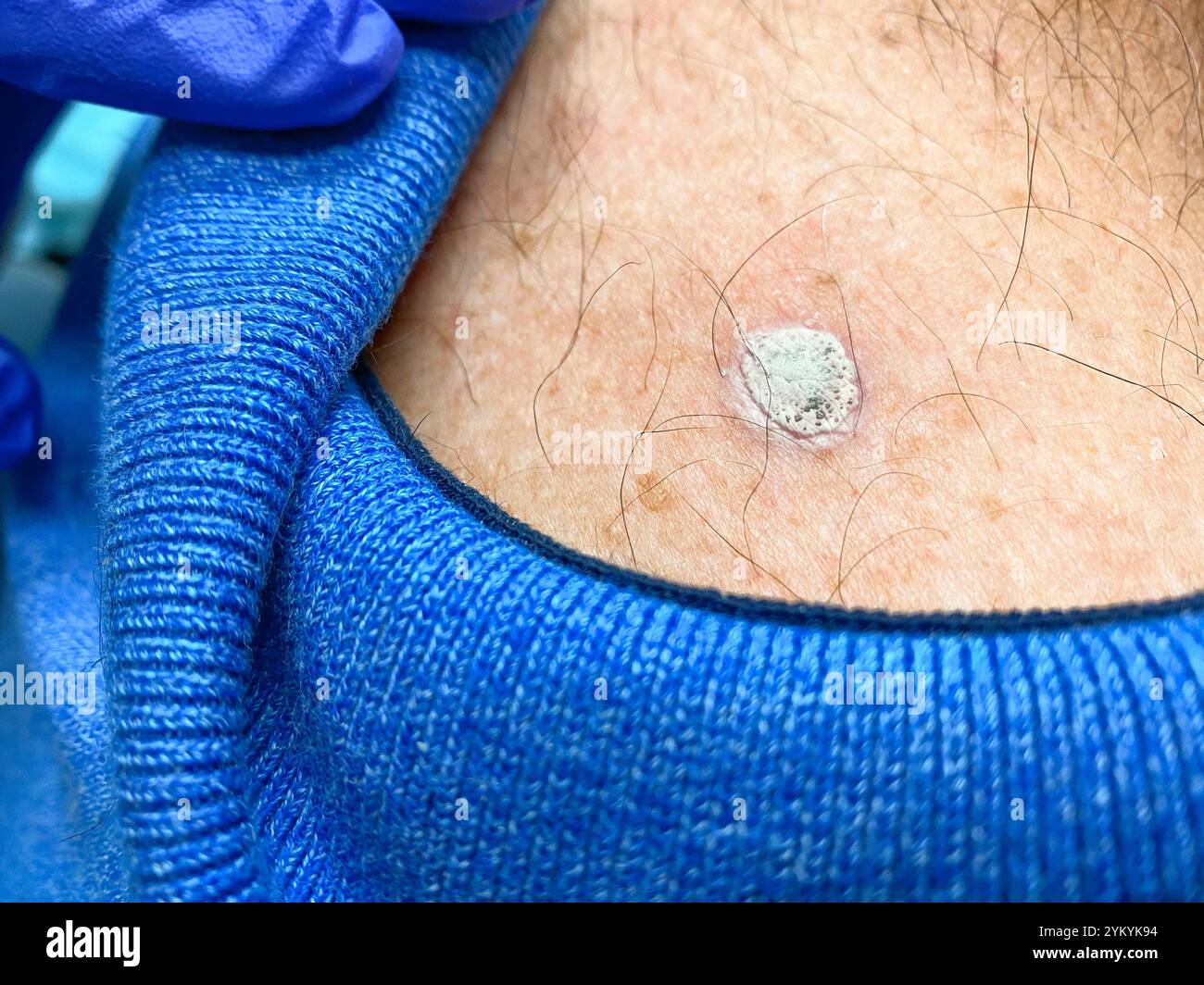 Cryosurgery for seborrheic keratosis Stock Photo - Alamy