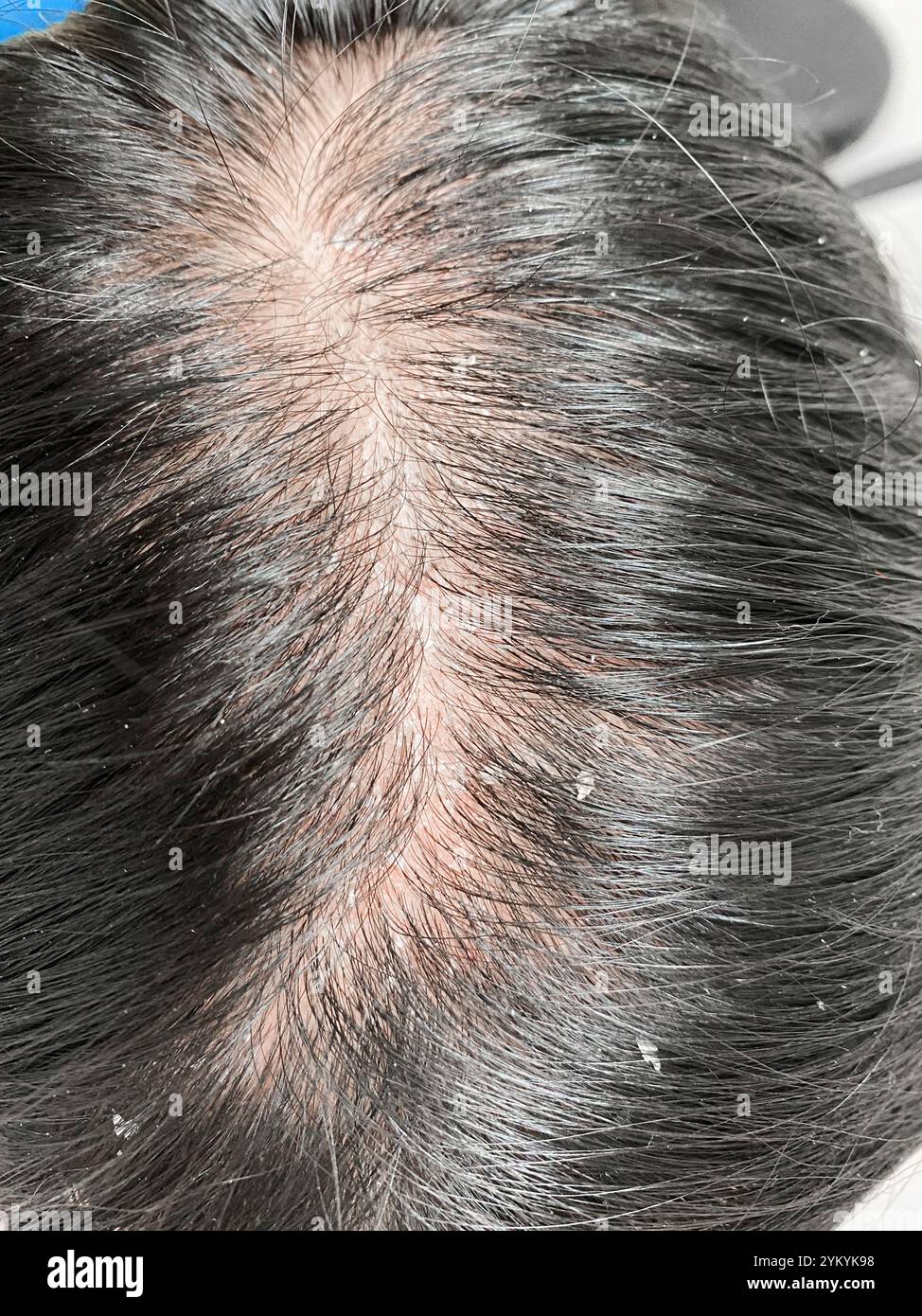 Seborrheic dermatitis on a patient's scalp. This is an inflammatory ...