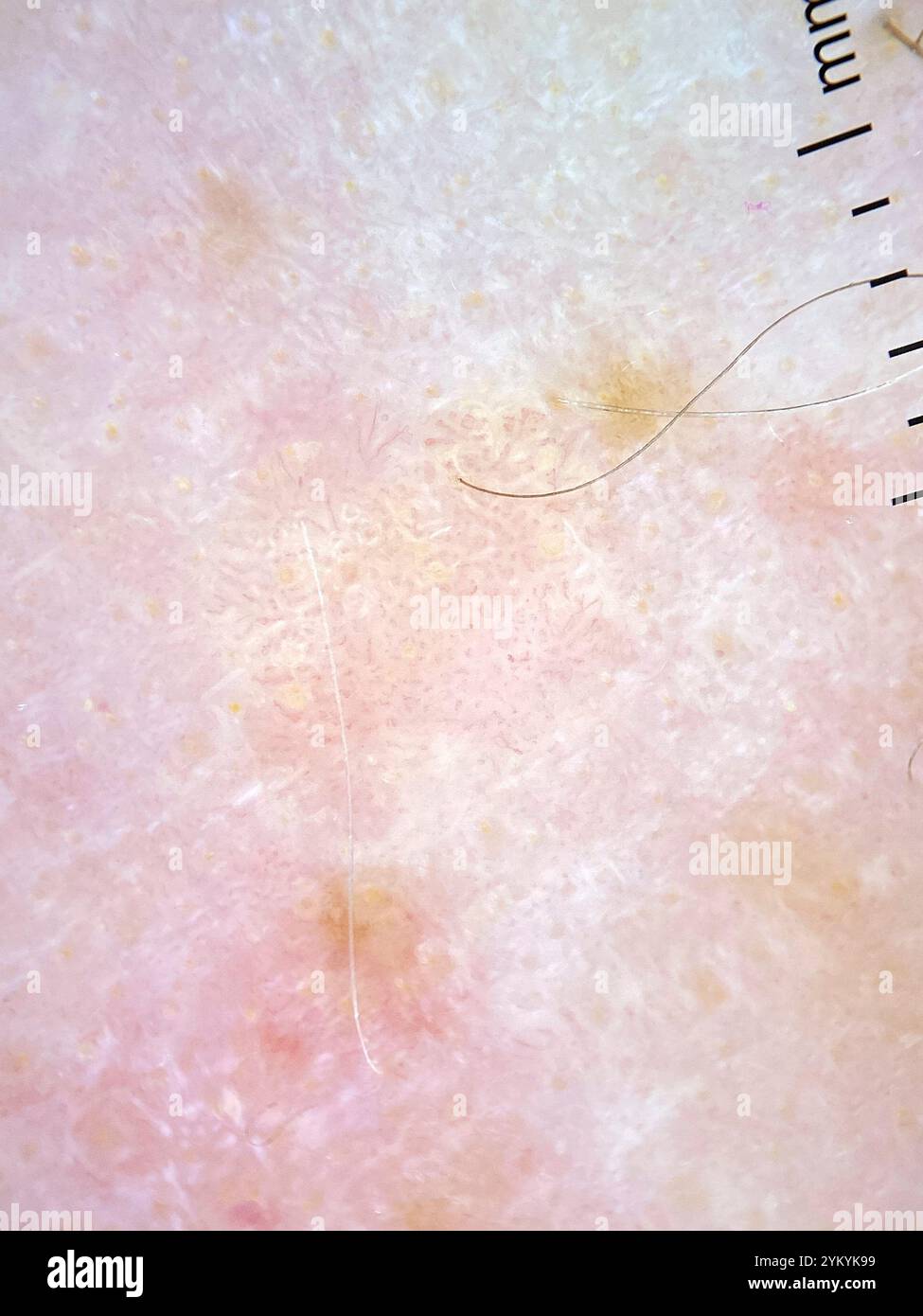 Dermatoscope image of seborrheic keratosis on a patient's scalp. This ...