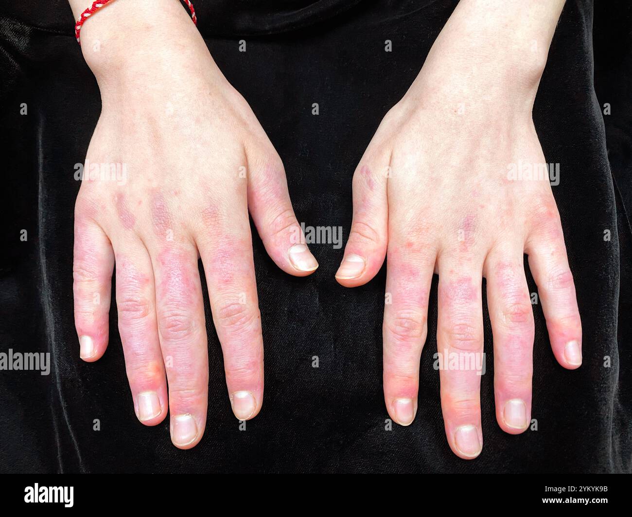 Raynaud's phenomenon in systemic lupus erythematosus Stock Photo - Alamy