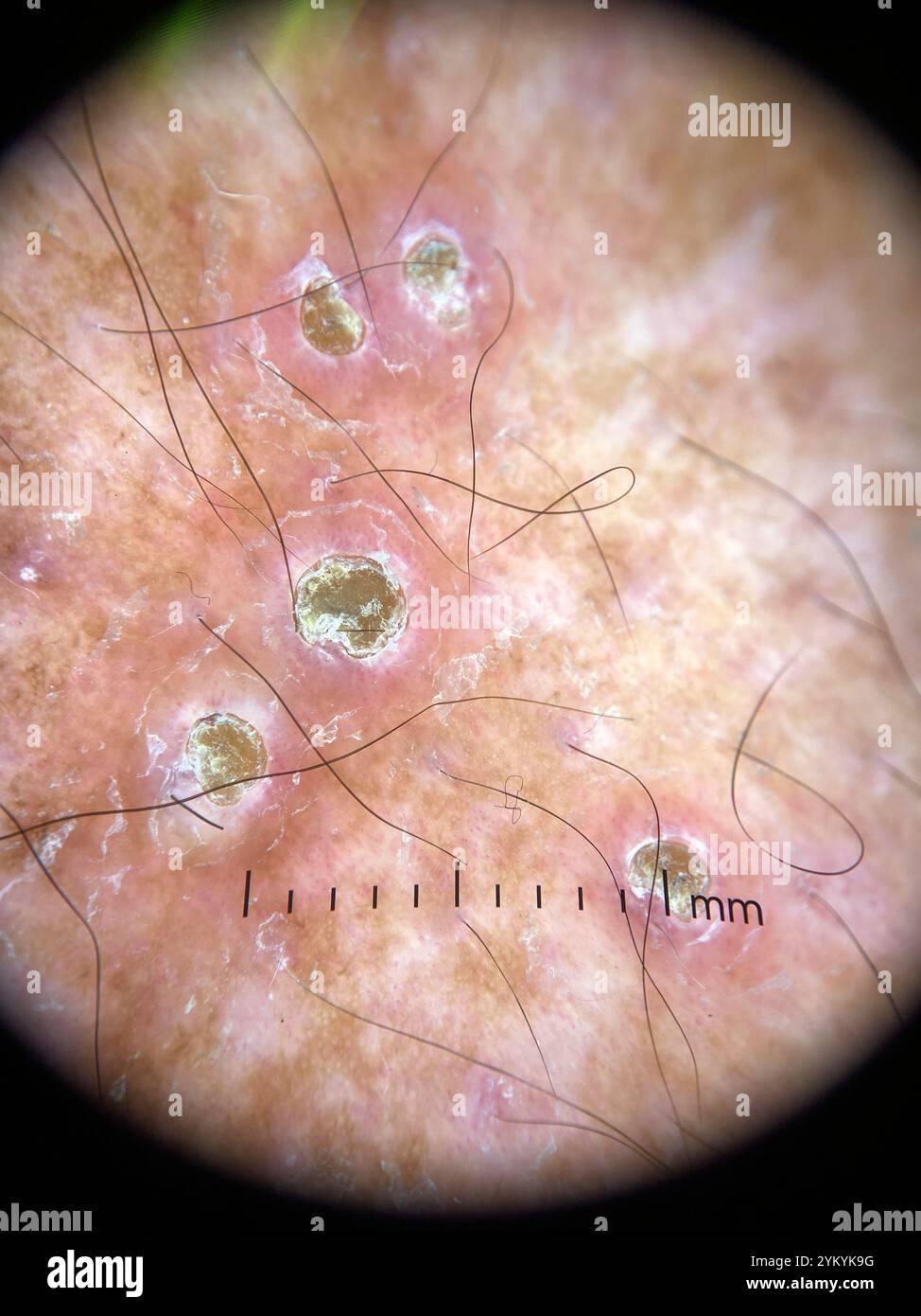 Dermatoscope image of lesions on the skin of a patient with perforating ...