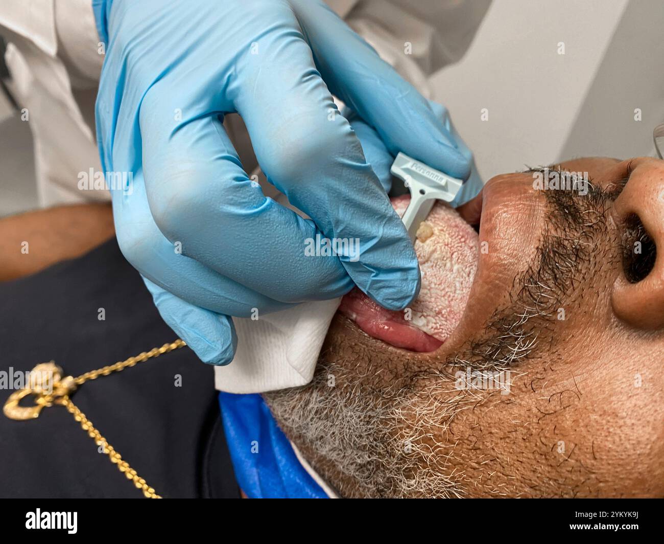 Doctor taking a shave biopsy of a lesion on the tongue of an African ...
