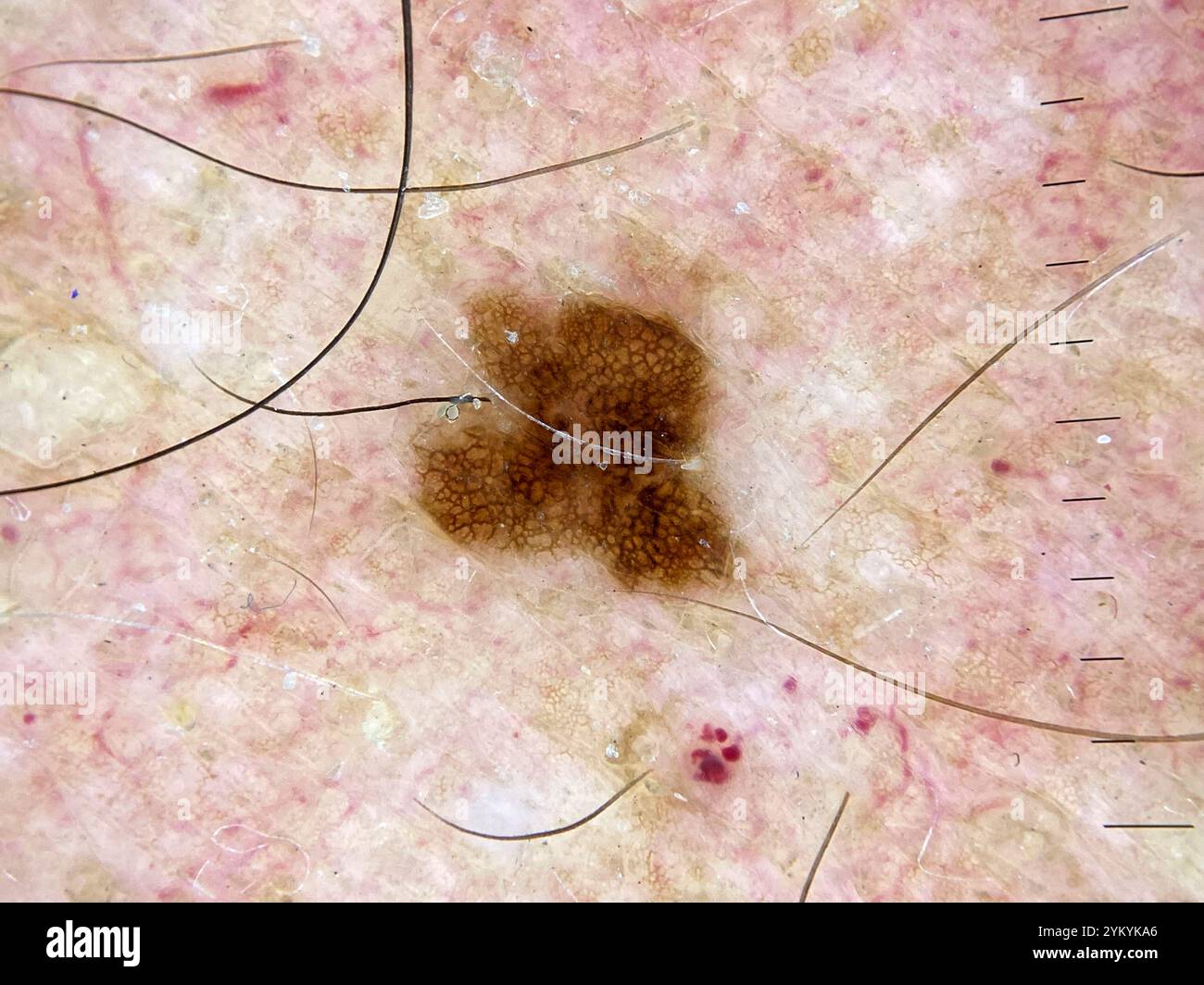 Dermatoscope image of a reticular, or acquired, naevus on a male ...