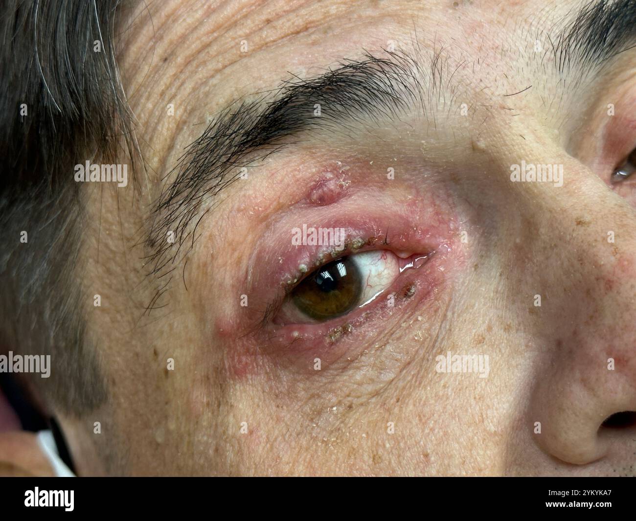 Pyoderma gangrenosum lesions around the eye of a patient who is being ...
