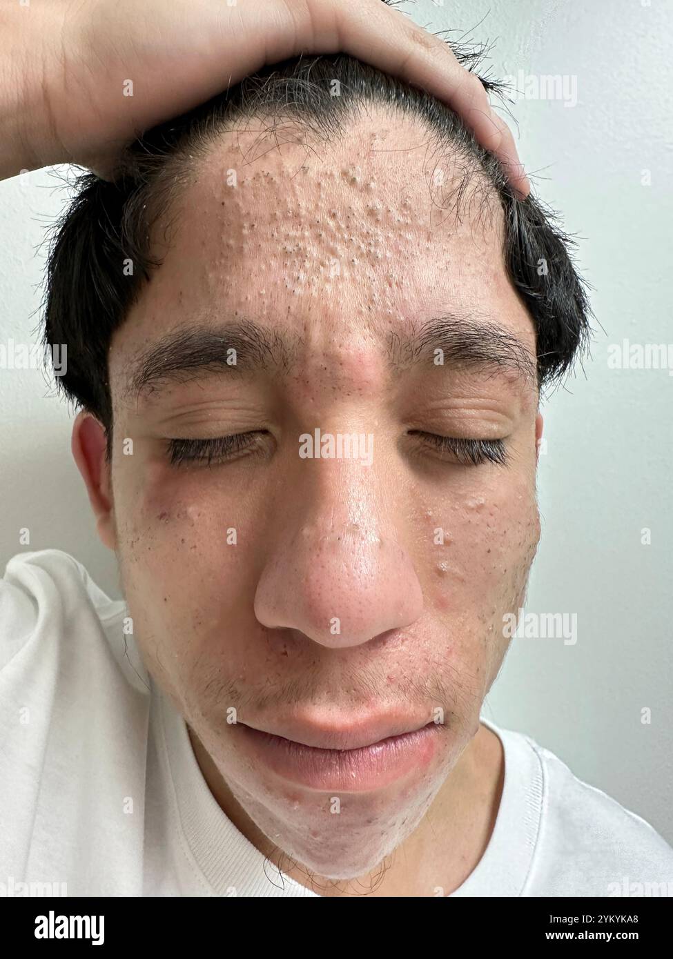 Severe acne on a patient's face. Acne is a general name given to a skin ...