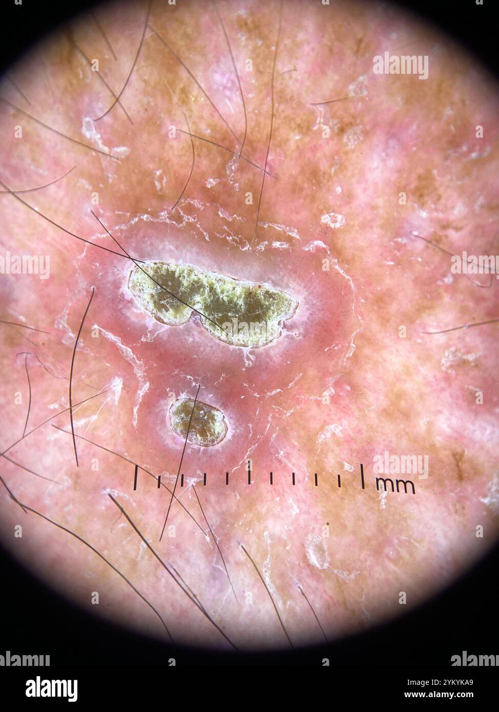 Dermatoscope image of lesions on the skin of a patient with perforating ...