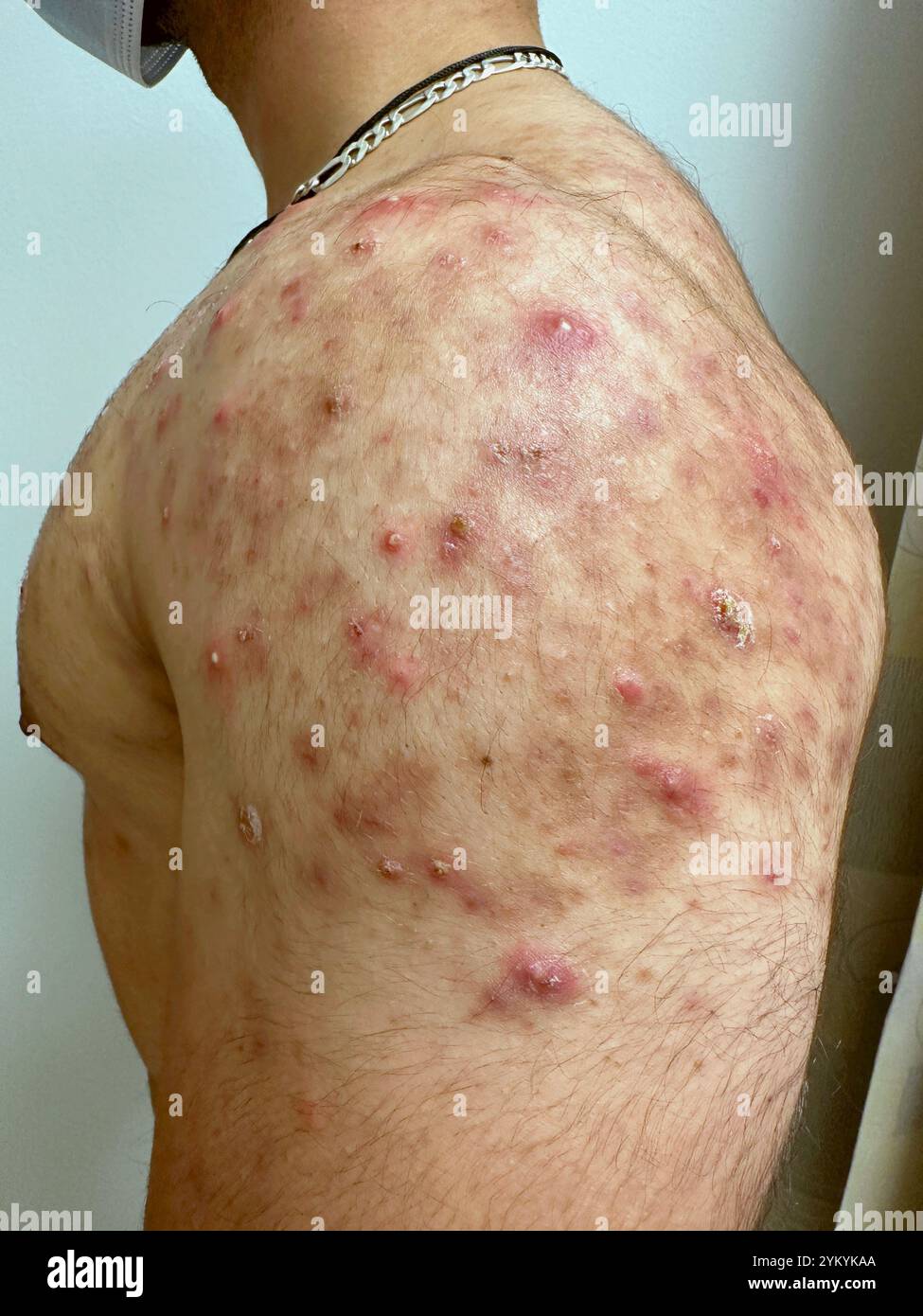 Shoulder of a patient whose acne is improving due to treatment with the ...
