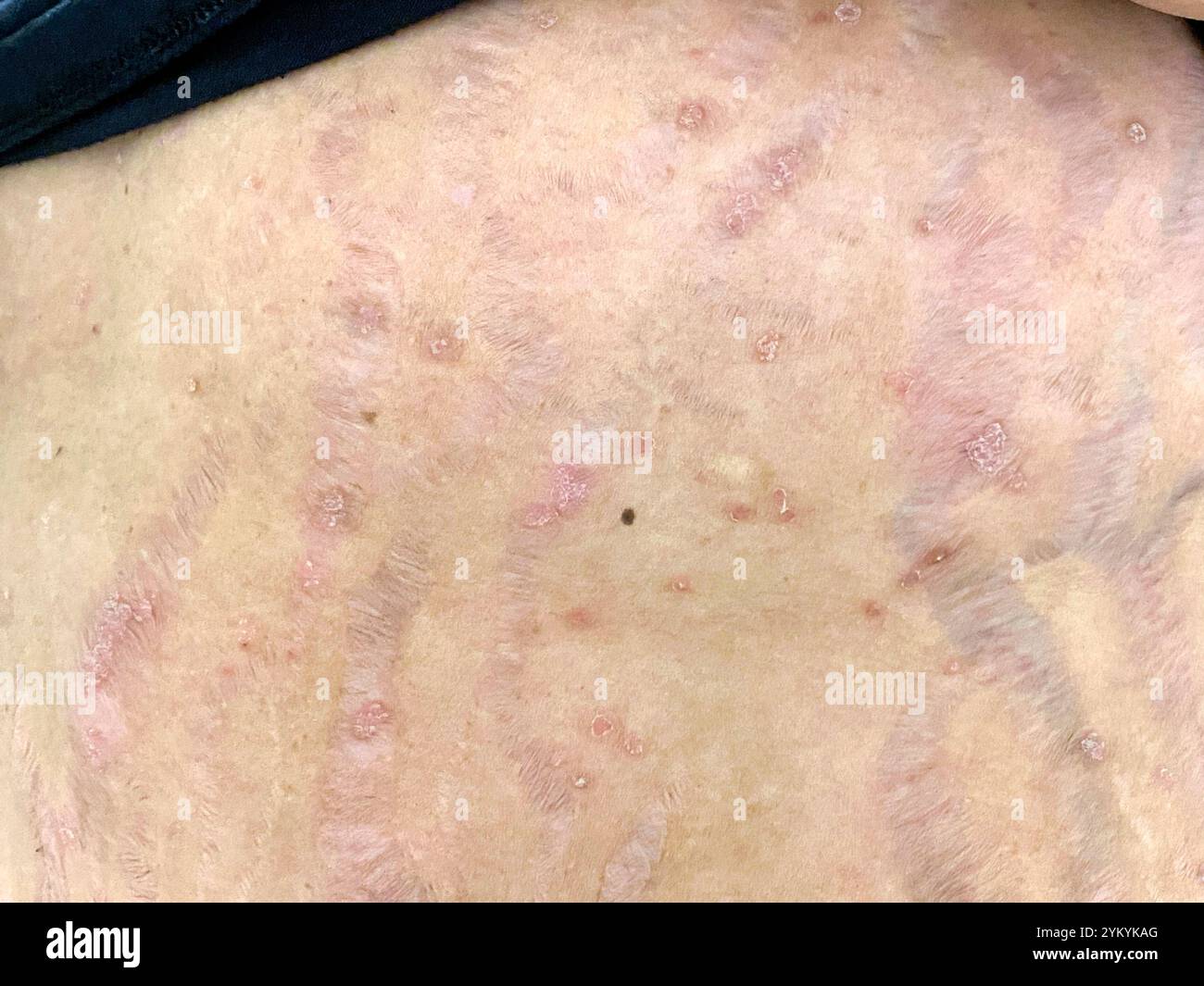 Reticular, or acquired, naevus (dark brown) on a patient's back. This ...